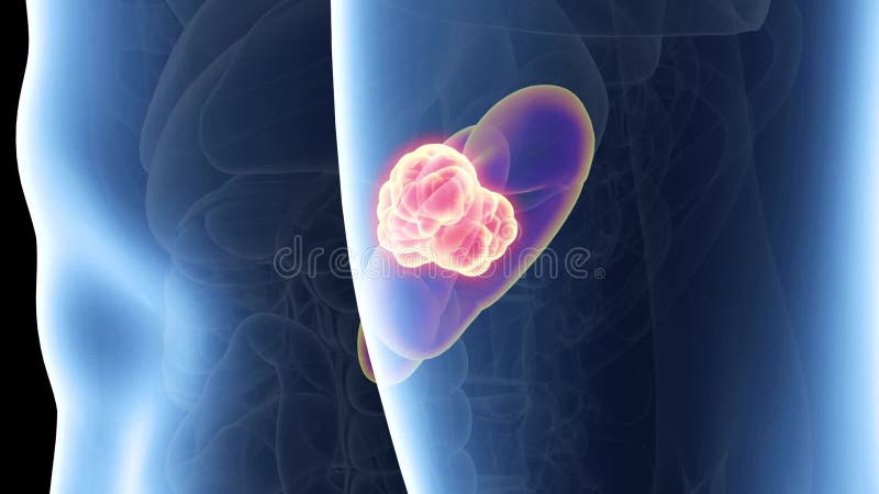 Kidney Cancer Renal Cell Carcinoma Ranal Pyramid Stock Video - Video of ...