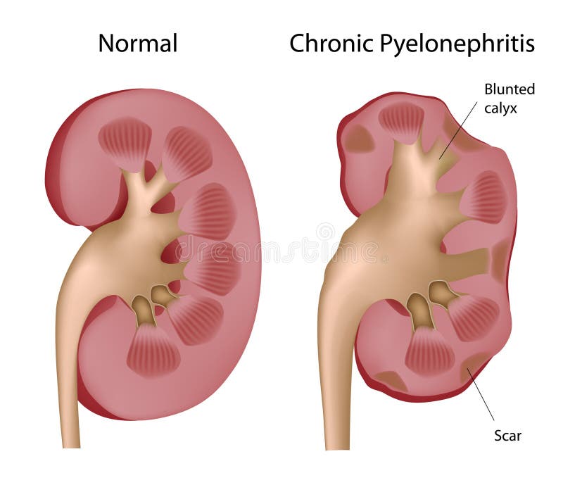 Kidney Chronic Pyelonephritis Stock Photography - Image: 22866262