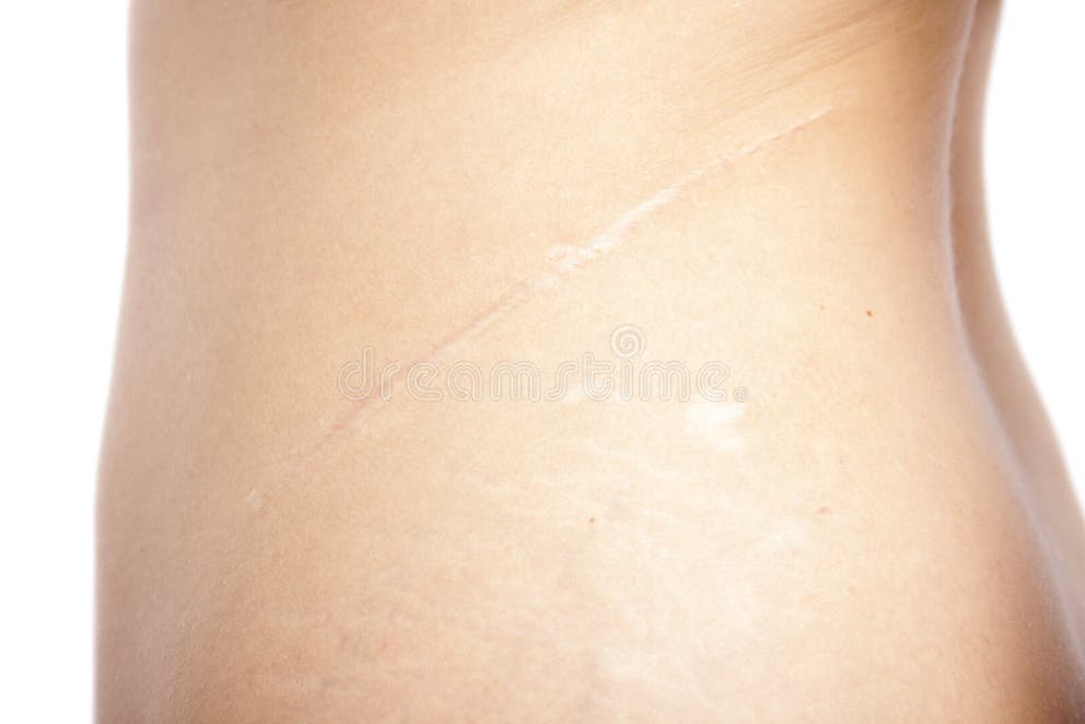 Kidney operation scar stock image. Image of abdomen, scar - 13282515