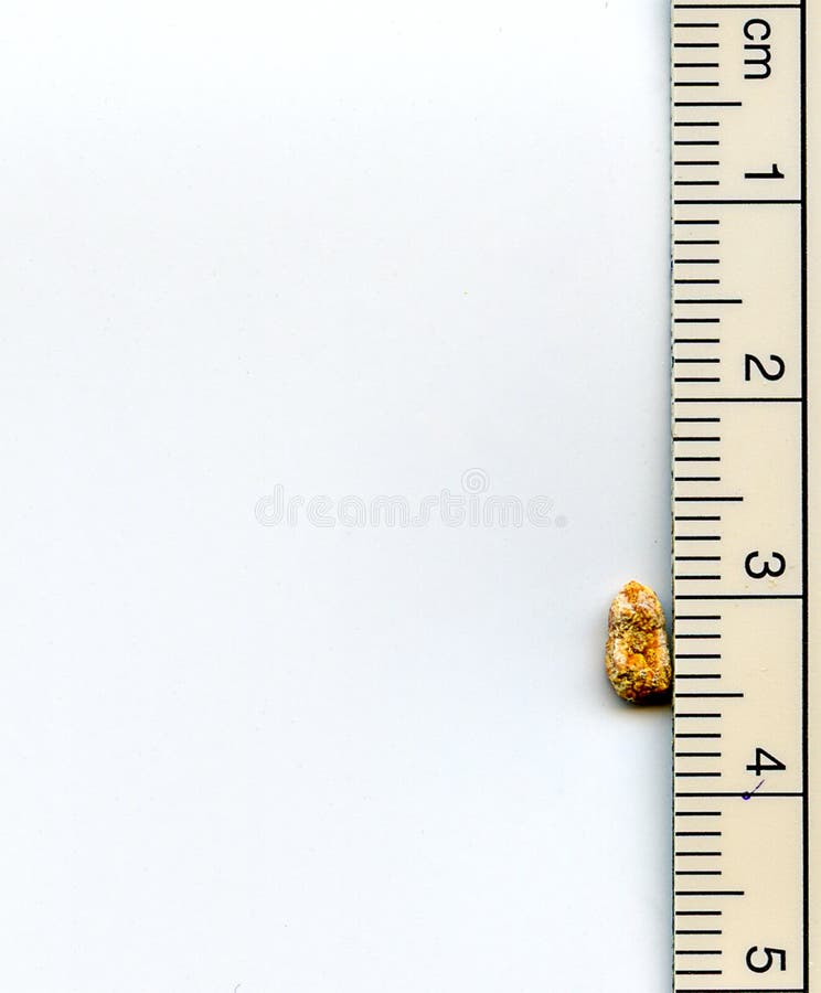 Kidney stone stock image. Image of millimeter, ruler - 194584799