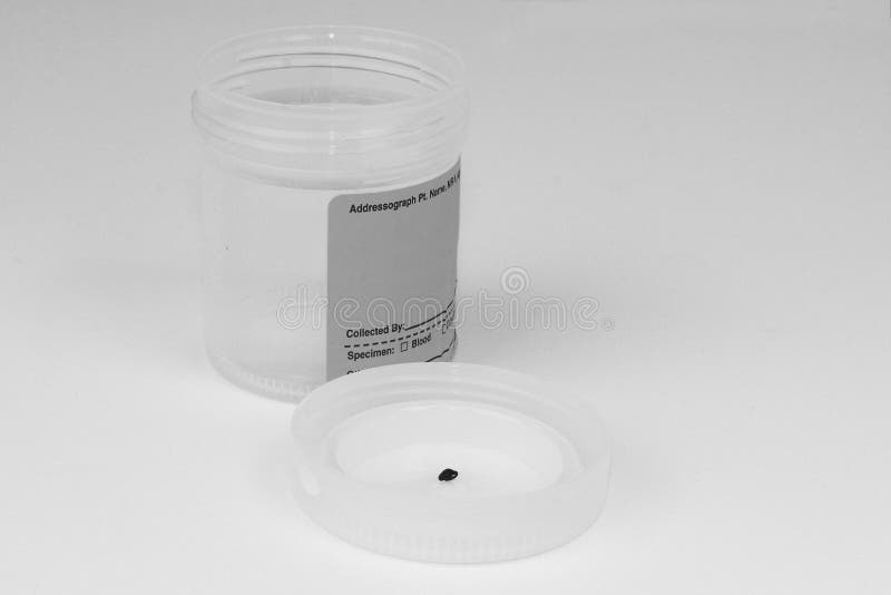 Kidney Stone in Lid of Specimen Cup Stock Image - Image of laboratory ...