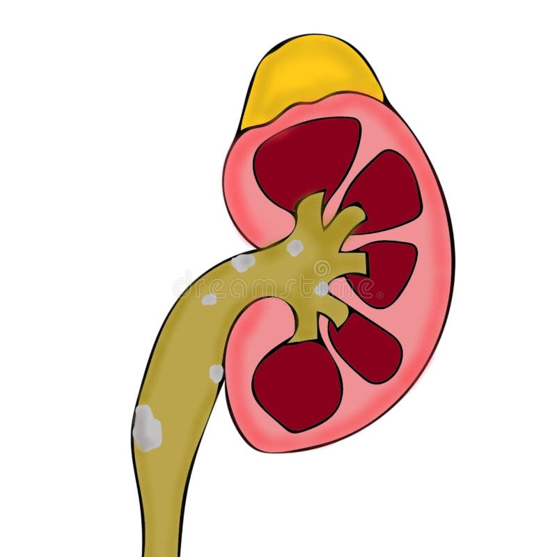 Kidney Stones on Kidney Illustration Medical Design Useful for Disease ...