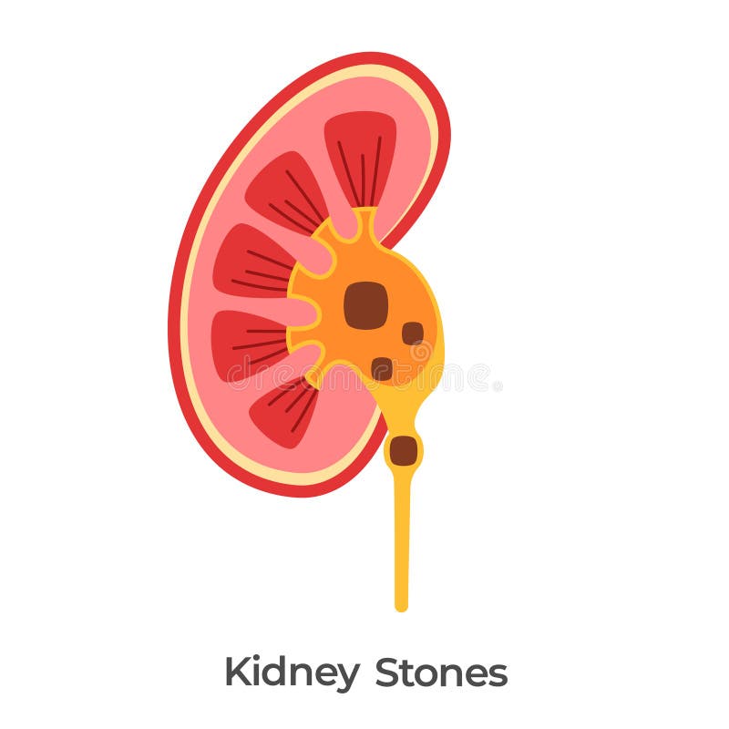 Urinary Stone Disease Stock Illustrations – 693 Urinary Stone Disease ...