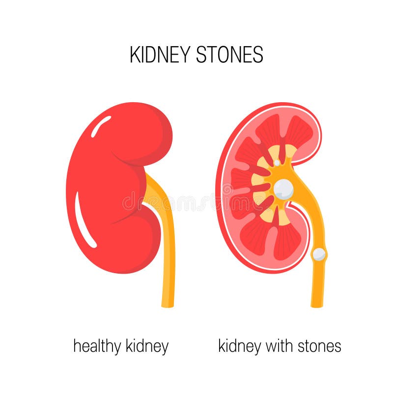 Cartoon Kidney Stone