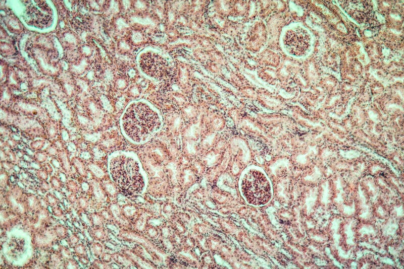 Kidney Tuberculosis Diseased Tissue Stock Image - Image of medicine ...