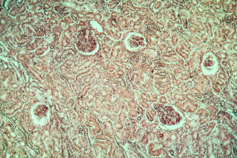 Kidney Tuberculosis Diseased Tissue Stock Photo - Image of microscopy ...