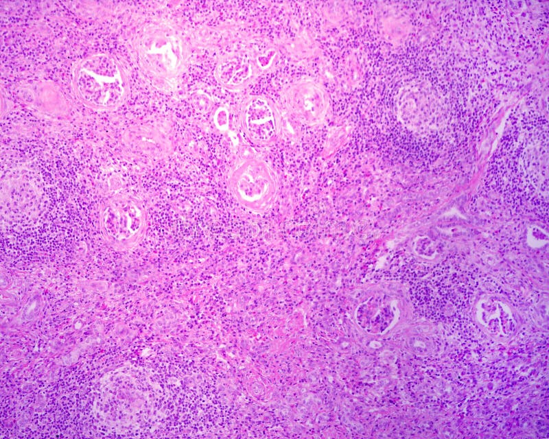 Kidney. Tuberculosis stock image. Image of microscopy - 379802217