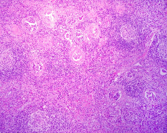 Kidney. Tuberculosis stock image. Image of microscopy - 379802217