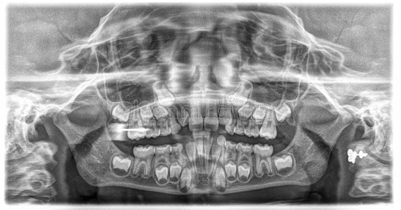Radiografie Van Kinderengebit Stock Afbeelding - Image of radiografie ...