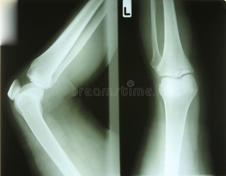 1,312 Leg Bones Knee Stock Photos - Free & Royalty-Free Stock Photos ...