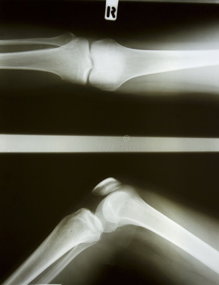1,312 Leg Bones Knee Stock Photos - Free & Royalty-Free Stock Photos ...
