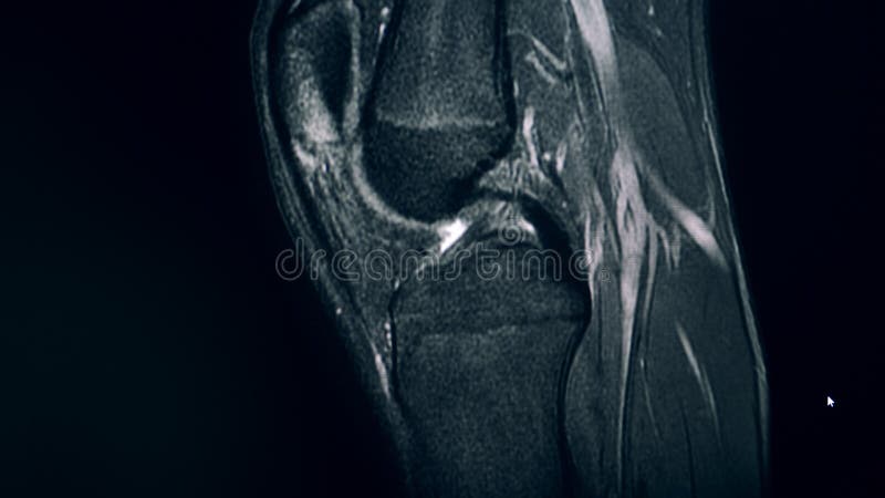 Knee Bones are Being Shown on MRI Scan Stock Footage - Video of ...
