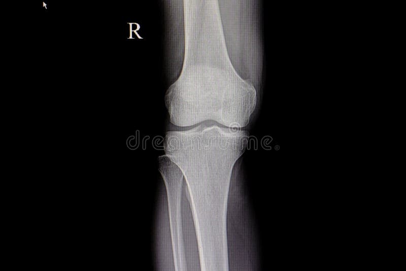 Knee Xray of a Patient Showing a Lucent Line at Lower Part of Patella ...