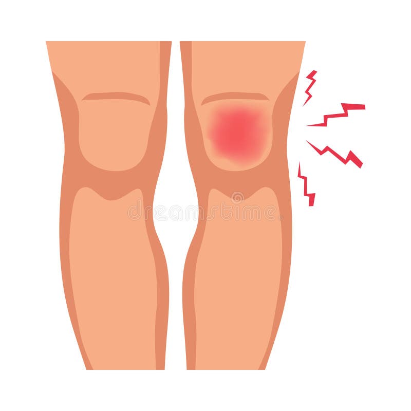 Knee Injury Illustration stock illustration. Illustration of injury ...