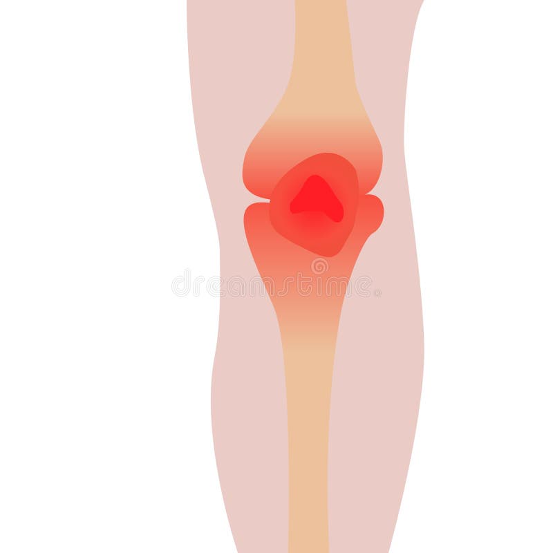 Knee injury stock vector. Illustration of inflamation - 97481097