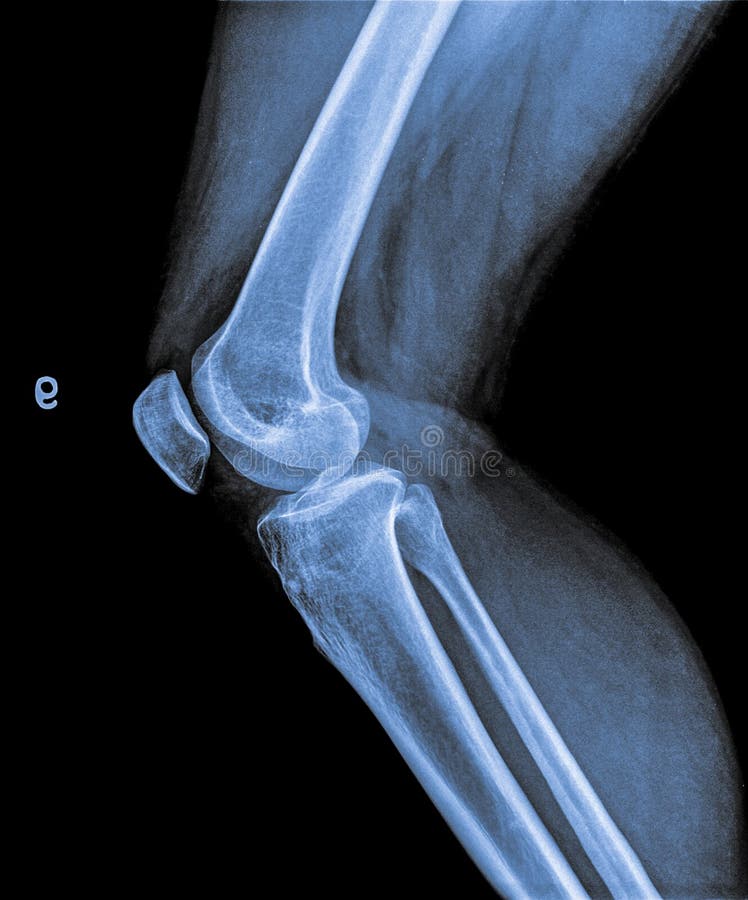 Knee Joint with Femur and Tibia Stock Photo - Image of femur, tibia ...