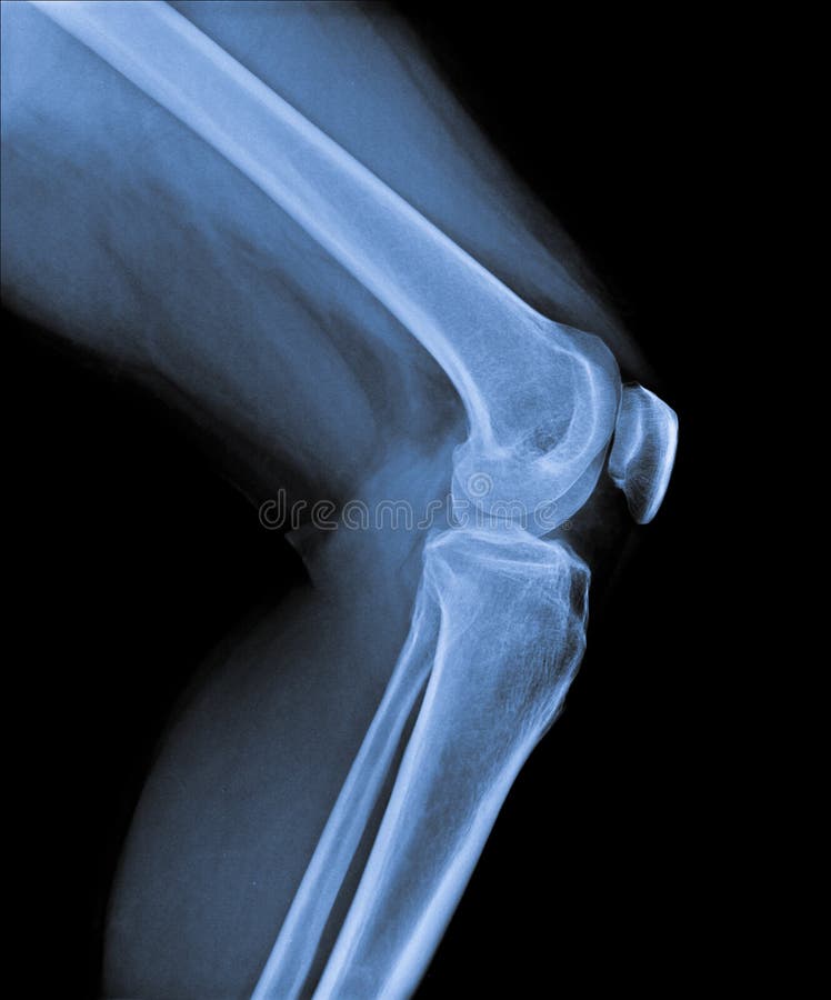 X Ray of Knee Joint with Femur, Tibia and Fibula Bone. Stock Photo ...