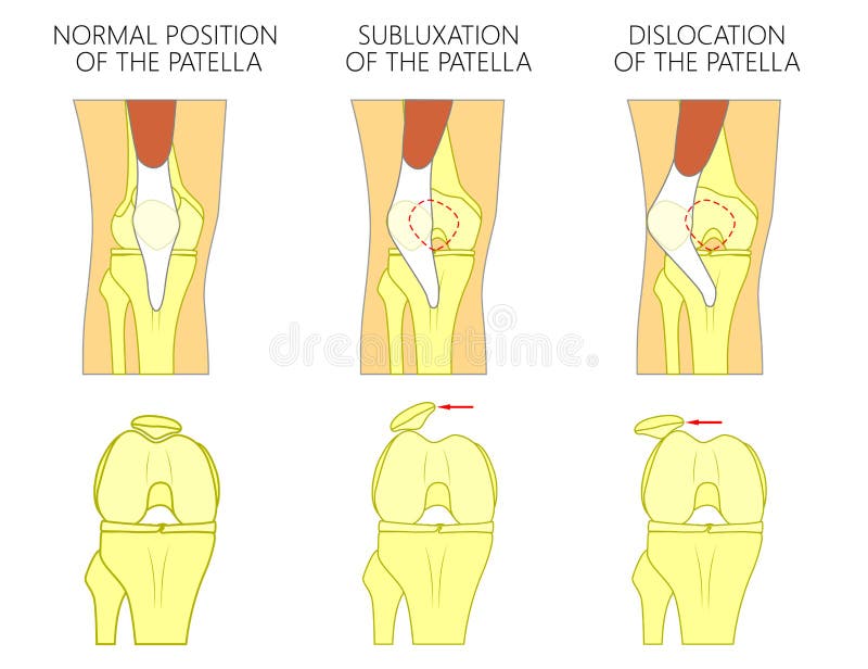 Knee Joint Problem_Dislocation of the Patella Stock Vector ...