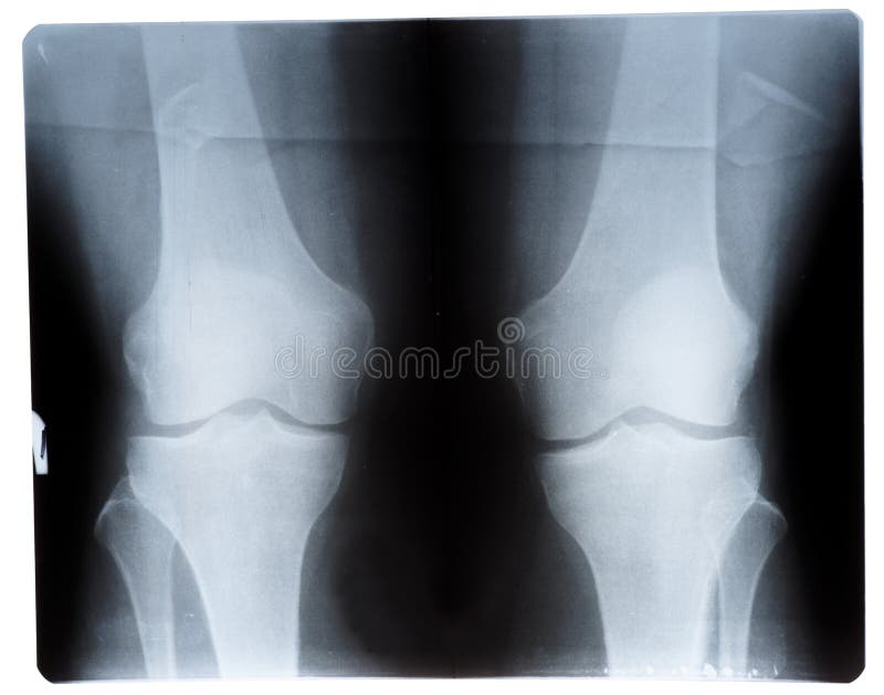 Osteoarthritis Knee ( OA Knee ). Film X-ray Both Knee ( Front View ...