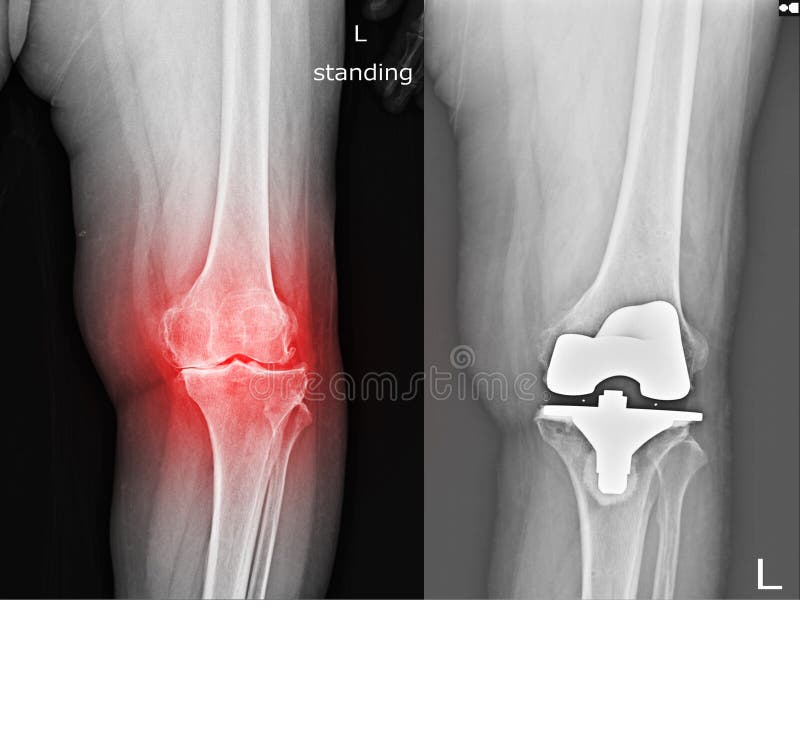 Knee Joint X-ray Showing Osteoarthritis and Bone Regeneration, with ...