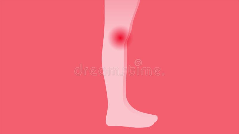 Knee Pain. Minimal Modern Seamless Motion Design Stock Video - Video of ...