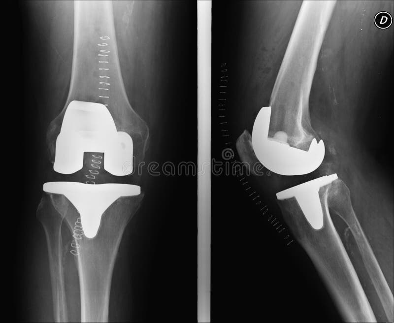 Knee with prosthesis stock photo. Image of female, recover - 19002452