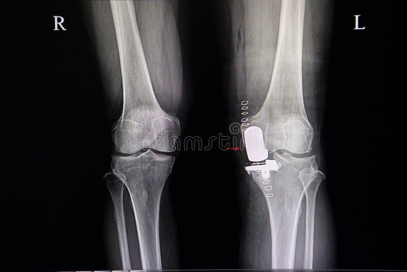 Prosthetic Leg and Knee Mechanism Stock Image - Image of revival ...