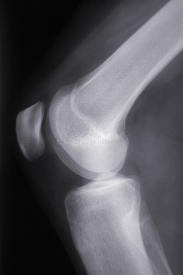 Knee X-ray stock image. Image of hospitals, hospital, tibia - 147463