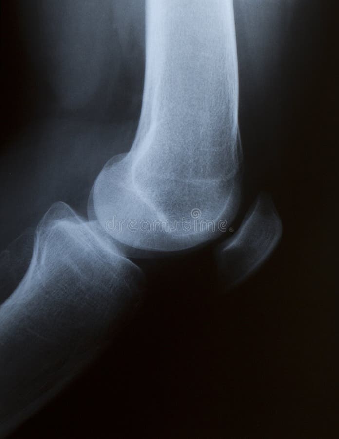 Knee X-ray stock image. Image of bone, roentgen, hospital - 23201121