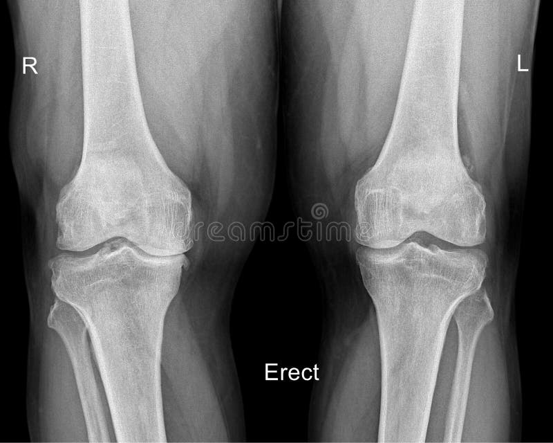 Knee X-Ray: Diagnostic Evaluation of Bone Structure Stock Image - Image ...
