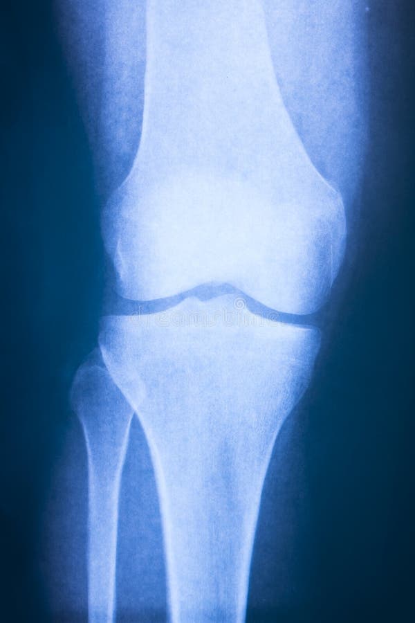 Knee x-ray. stock image. Image of adult, anatomy, medicals - 79754265