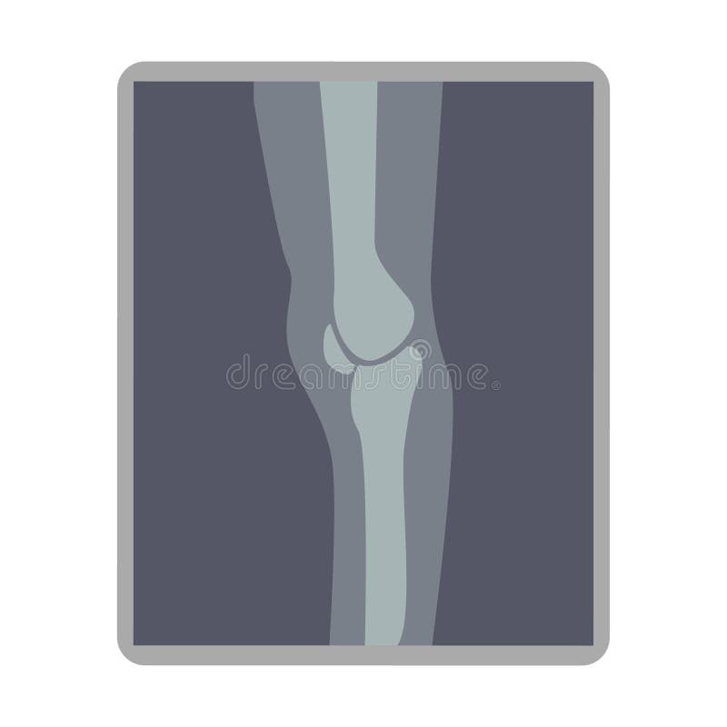 Fracture Avulsion Stock Illustrations – 35 Fracture Avulsion Stock ...