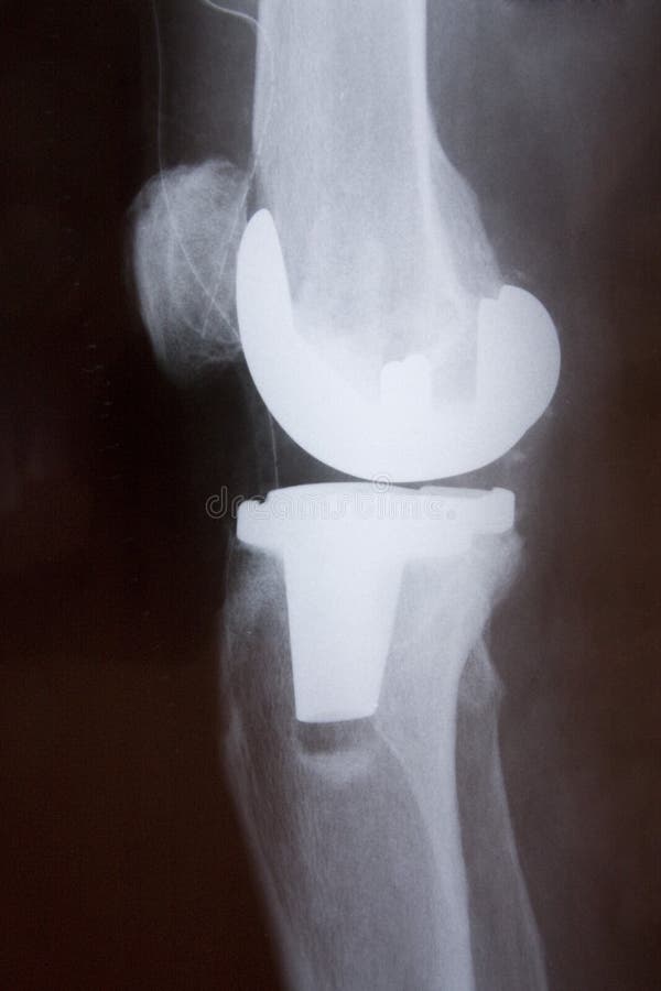 Knee x-ray picture stock image. Image of radiation, practise - 9312135