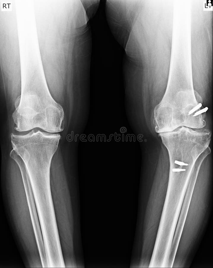 Knee X-rays Image Showing Plate and Fixation Stock Photo - Image of ...