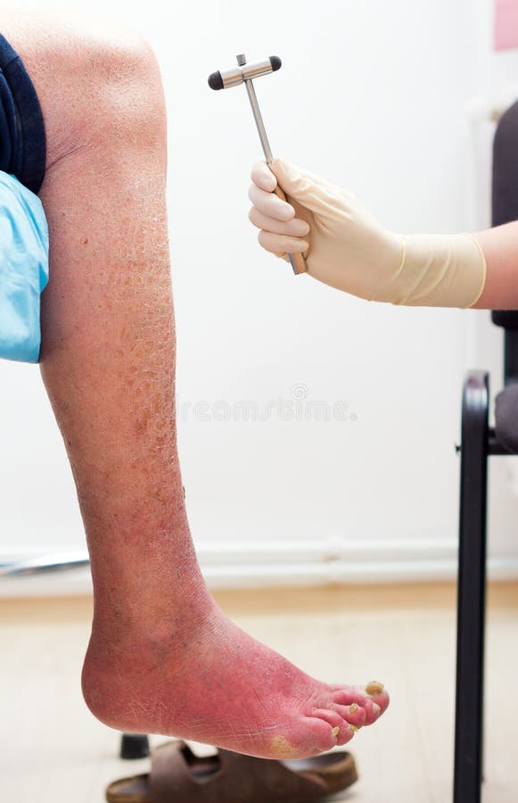 Knee Reflex stock image. Image of orthopedic, study, patient - 55292313