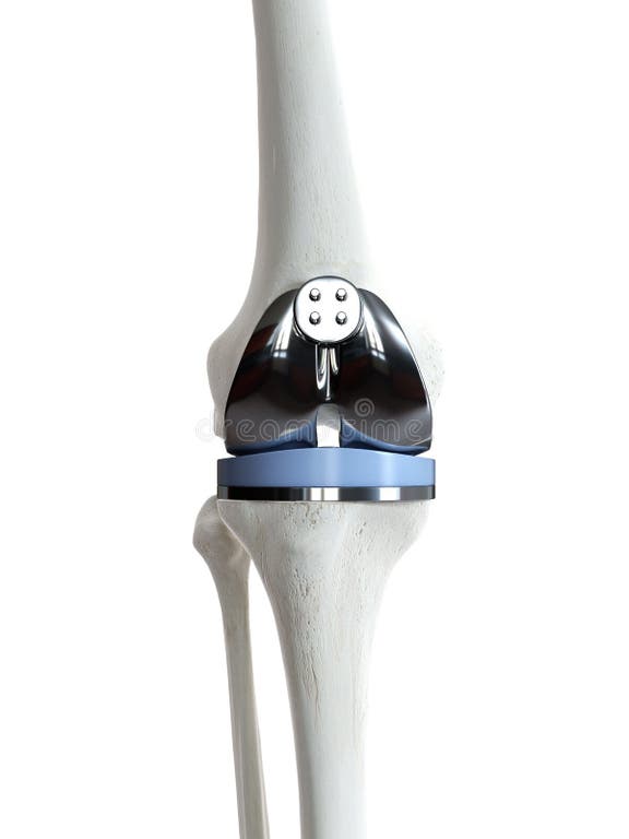 Knee Replacement Stock Illustrations – 907 Knee Replacement Stock ...