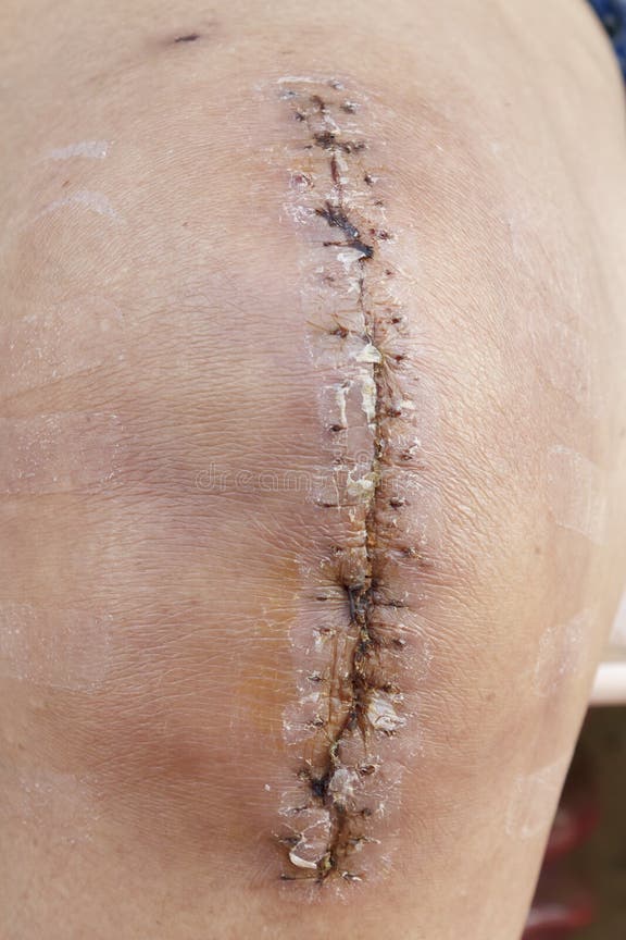 Knee replacement incision stock image. Image of human - 25668053