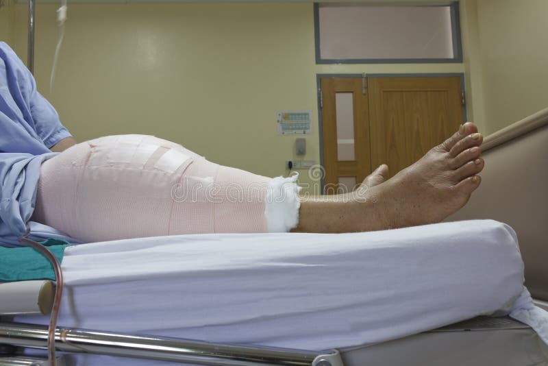 Knee replacement incision stock image. Image of healthcare - 28004581