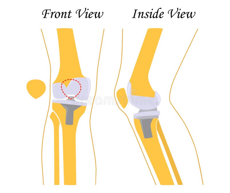 Knee Replacement. Joint Prosthetics. Knee Endoprosthesis. Vector ...