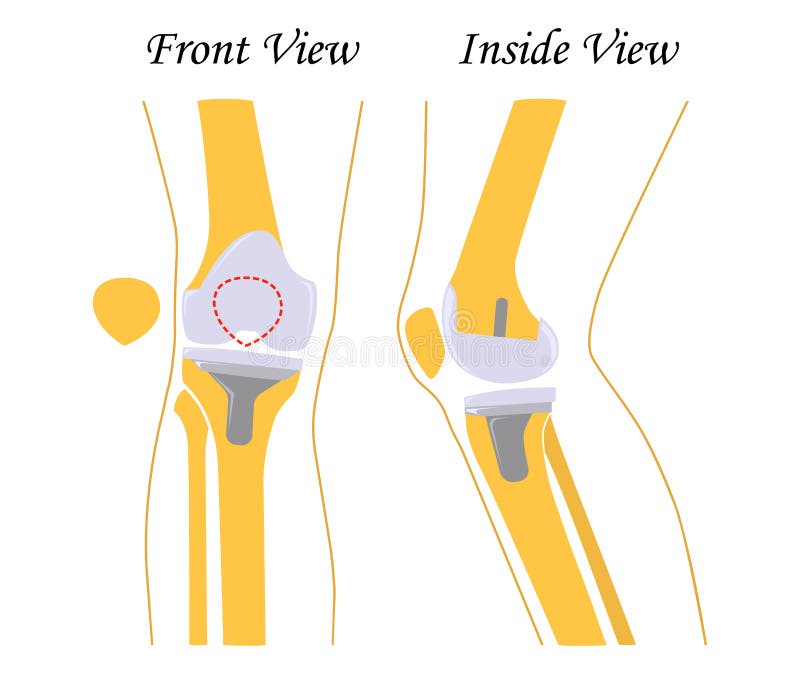 Knee Replacement. Joint Prosthetics. Knee Endoprosthesis. Vector ...