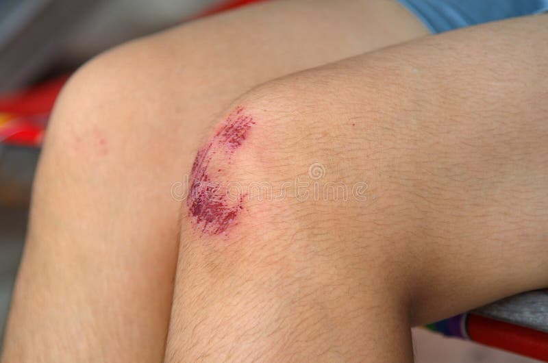Knee wound accident. stock image. Image of background - 76286193