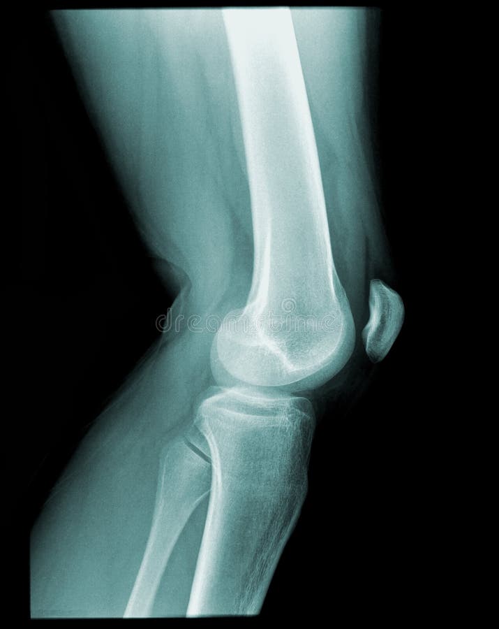 Knee X-ray Royalty Free Stock Image - Image: 12945766