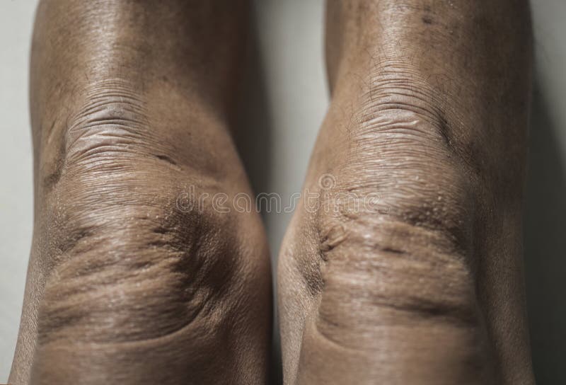 Knees and Wrinkled Skin of the Elderly Stock Image - Image of ...