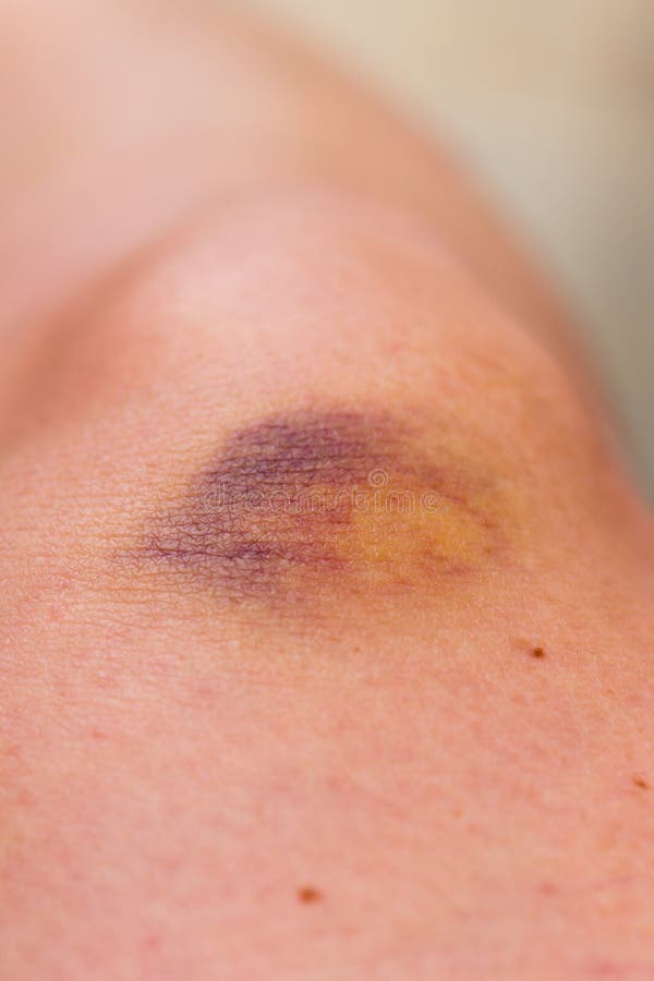 Kneuzing op een knie stock afbeelding. Image of been - 32782025