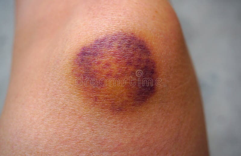 Kneuzing op gewonde stock afbeelding. Image of huid, stomp - 72426705