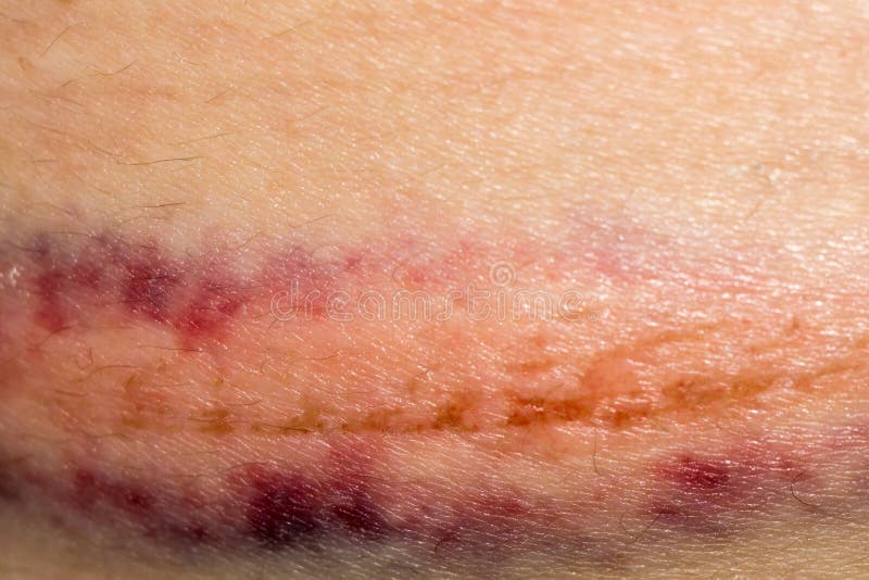 Een Kneuzing Op De Huid Van Een Persoon Stock Afbeelding - Image of ...