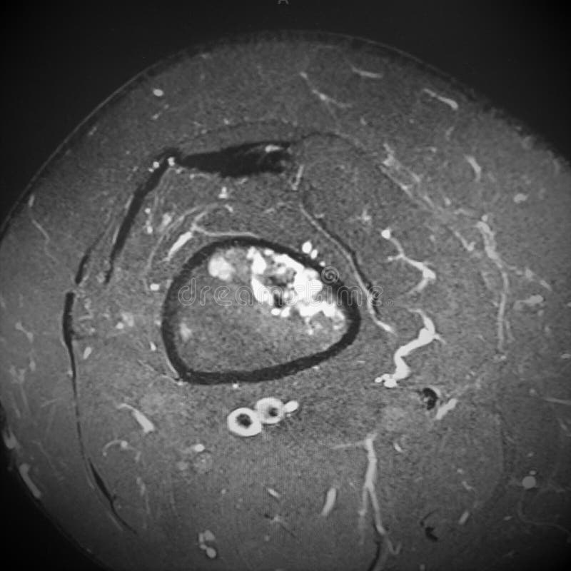 KNOCHEN-Onkologiesarkom Mri Schenkel Stockfoto - Bild von pathologie ...