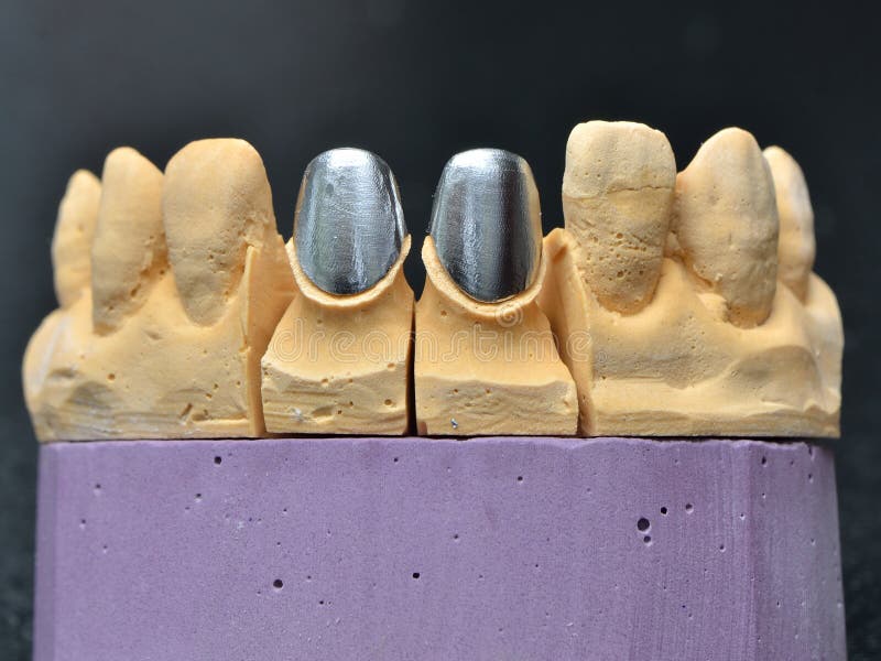 Komposit inympad tandkrona fotografering för bildbyråer. Bild av ...