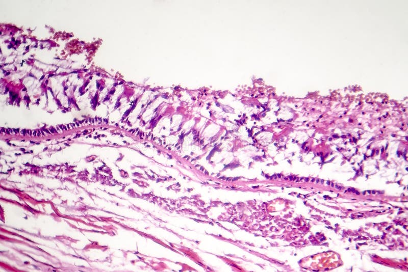 Kronisk Bronkit Under Mikroskopet Arkivfoto - Bild av morfologiskt ...