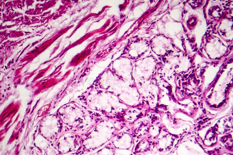 Kronisk Bronkit - Text I Medicinsk Historia 3d Arkivfoto - Bild av kemi ...